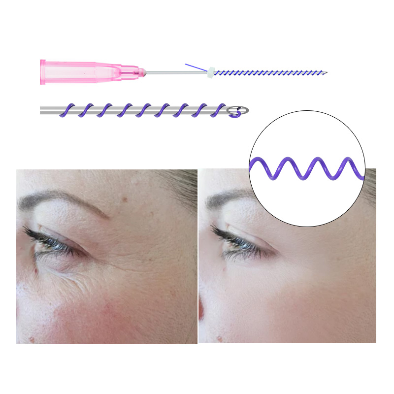 Factory Wholesale Mono Screw Thread PDO PCL PLLA For Face Lift